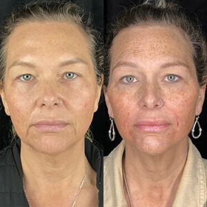 Student Before & After | Injector Coach Institute in Pensacola, FL