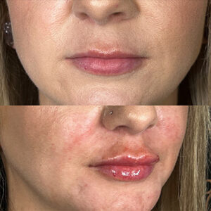 Aesthetic Injector Training | Pensacola, FL | Injector Coach Institute